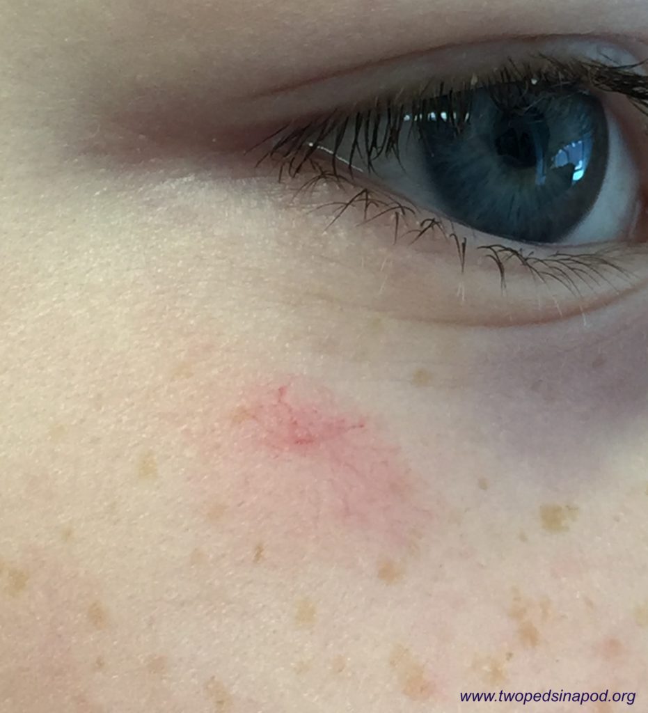 What s That Red Mark On My Child s Face Picture Puzzle Of The Day What s That Red Mark On My Child s Face Picture Puzzle Of The Day